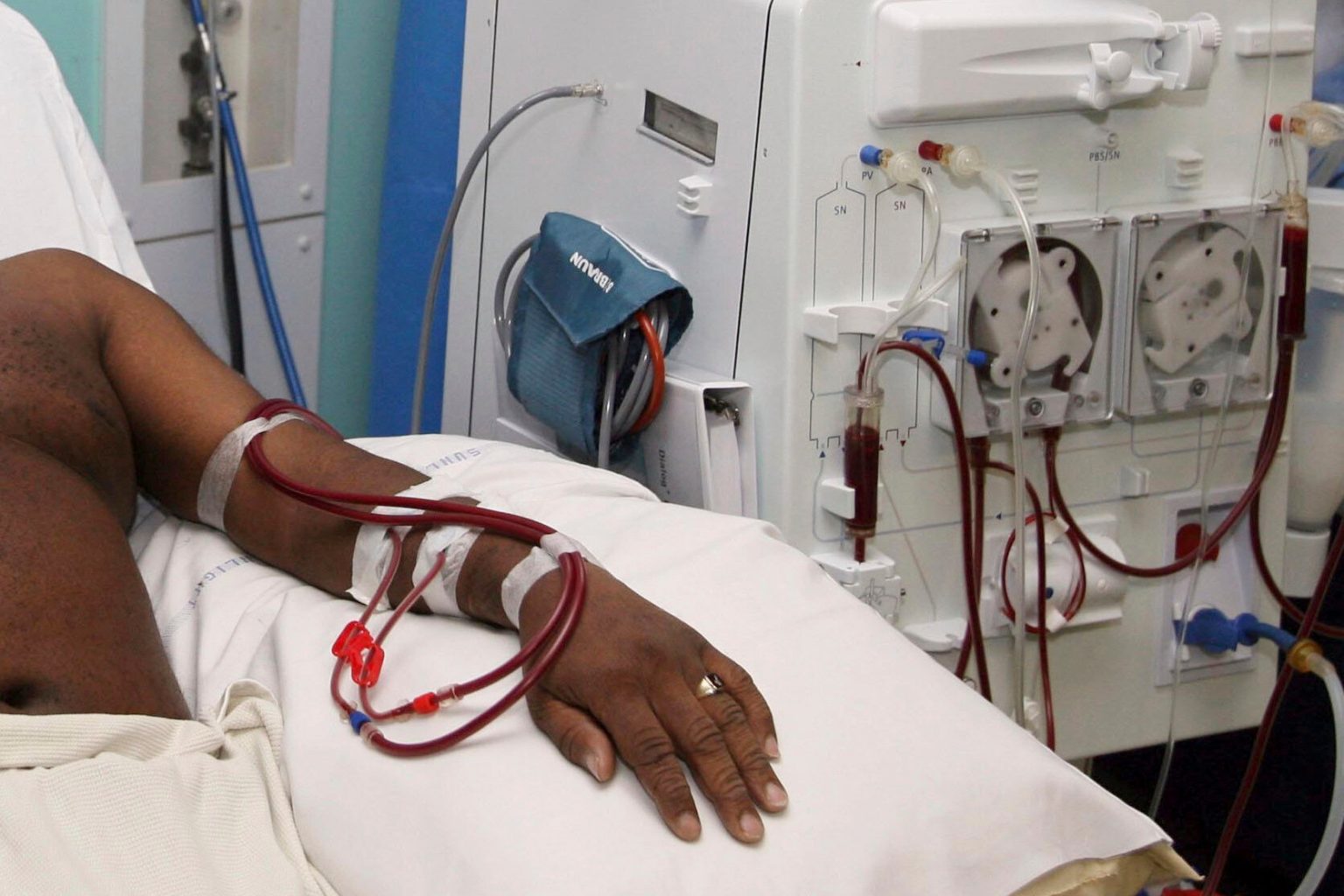 We need about 25 more dialysis machines to effectively operate - KATH ...